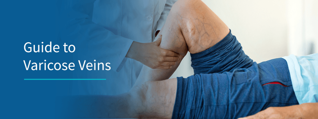 Varicose Vein Stages | Early Stages | CF Vein Clinic