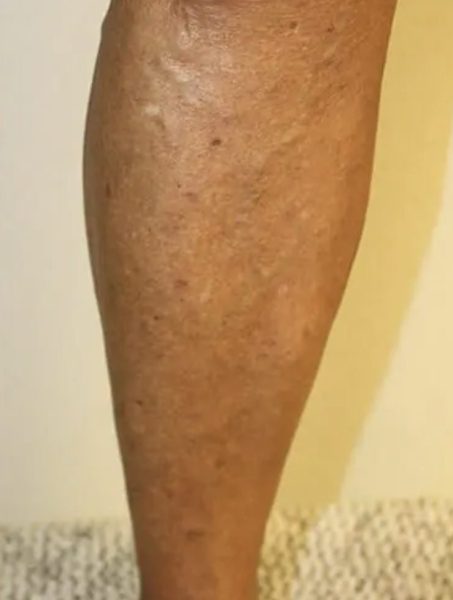 Microphlebectomy In Central Florida | Ambulatory Phlebectomy