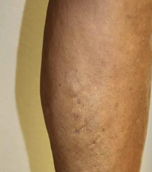 Microphlebectomy In Central Florida | Ambulatory Phlebectomy