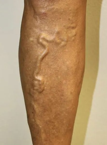 Microphlebectomy In Central Florida | Ambulatory Phlebectomy