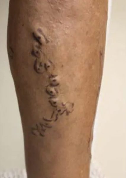 Microphlebectomy In Central Florida | Ambulatory Phlebectomy